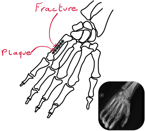 Les fractures de métacarpiens des doigts longs - Membre-Superieur
