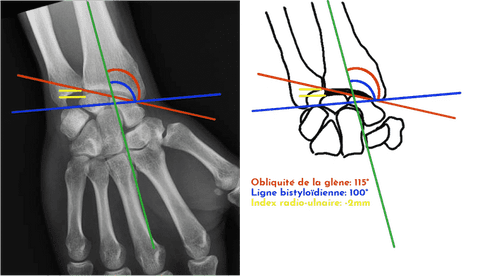 pouteau-colles - Membre-Superieur