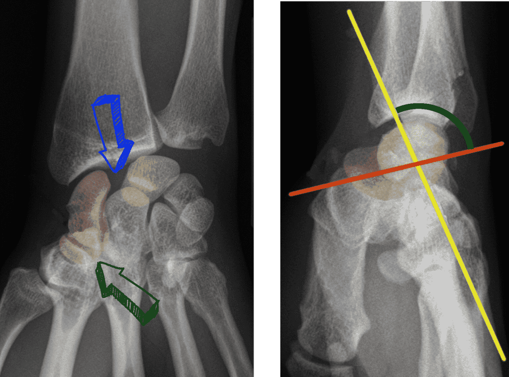 Entorse scapho-lunaire - Membre-Superieur